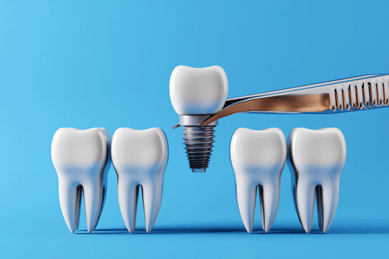 Your Comprehensive Guide on Dental Implants: The Best Replacement of ...