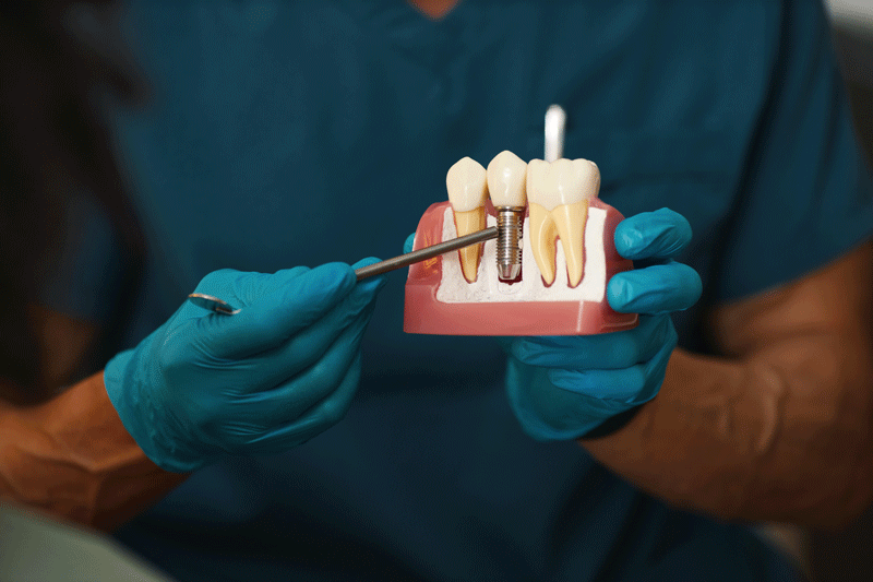 Understanding the Molar Implant Procedure: A Comprehensive Guide ...