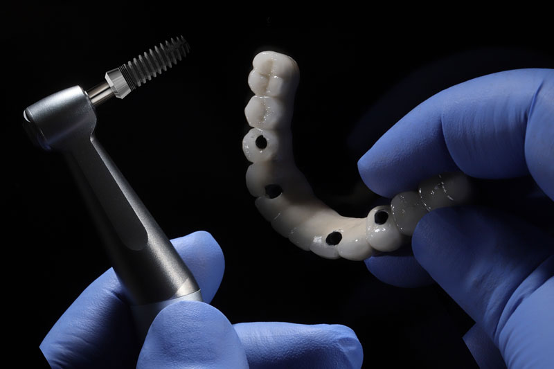 Making Dental Implants More Affordable: A Comprehensive Guide - Dentist ...