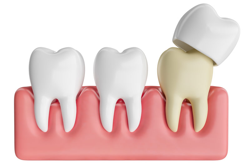 Breaking Down the Cost of a Gold Crown with Insurance: Essential Facts ...